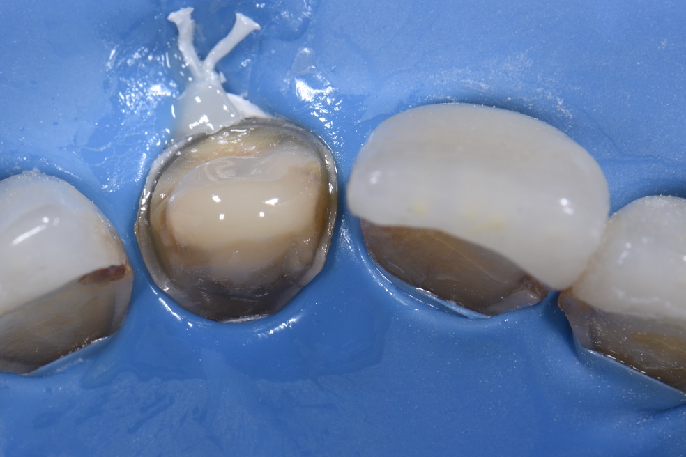 Freehand Composite Crown Fabrication to match Porcelain Veneers