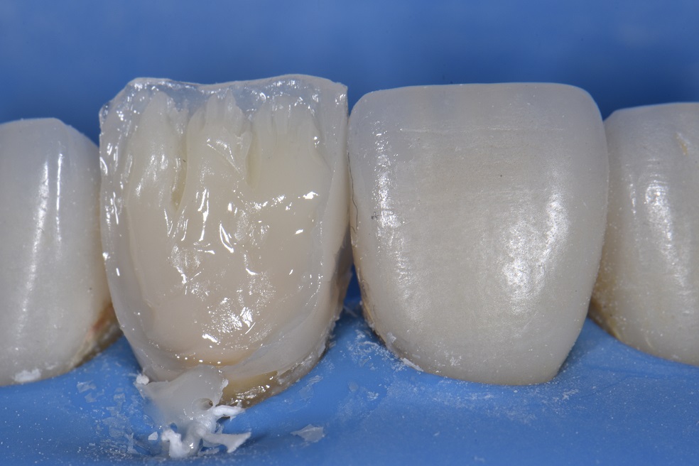 Freehand Composite Crown Fabrication to match Porcelain Veneers