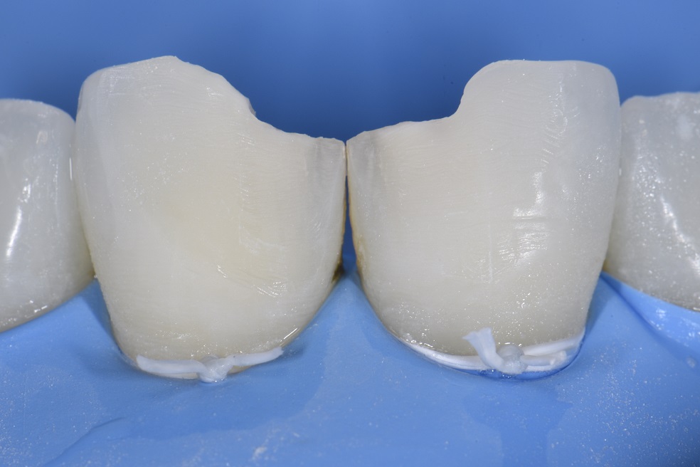 Class IV Fracture Replacement Restorations