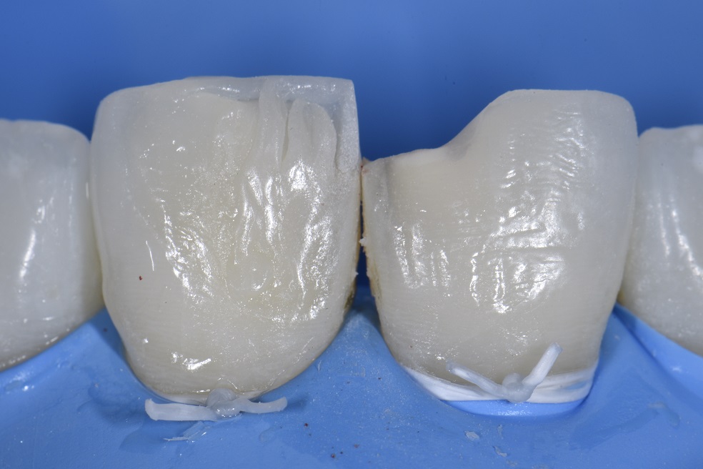 Class IV Fracture Replacement Restorations