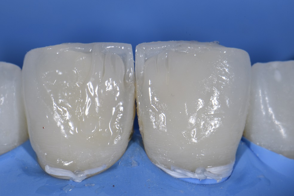 Class IV Fracture Replacement Restorations