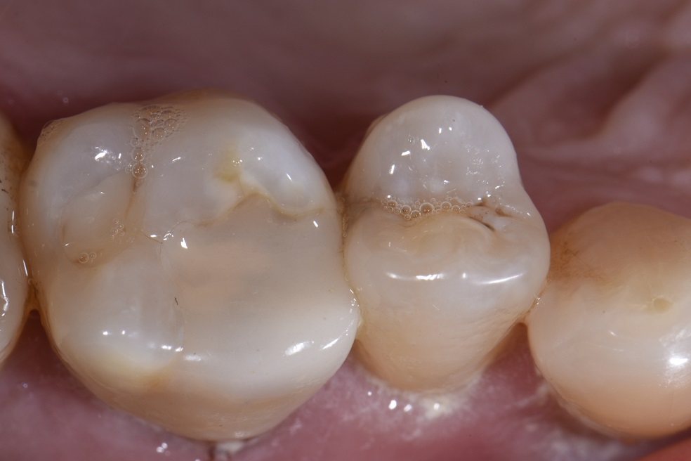 Nature Mimicking Composite Fillings