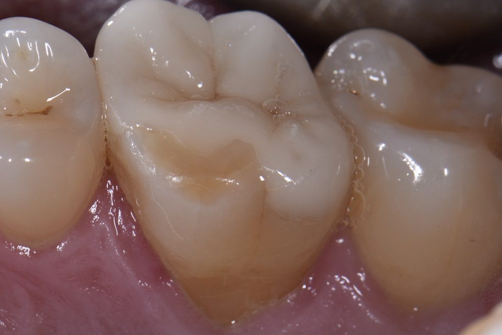 Treating Sensitive Teeth with Beautifully Skulpted Composite Resin