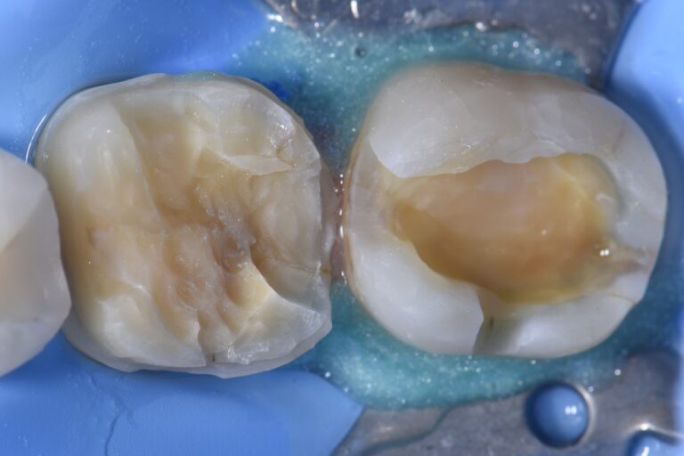 Removing Cracks and Supporting Residual Tooth Structure