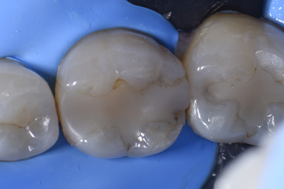 MOD composite restorations