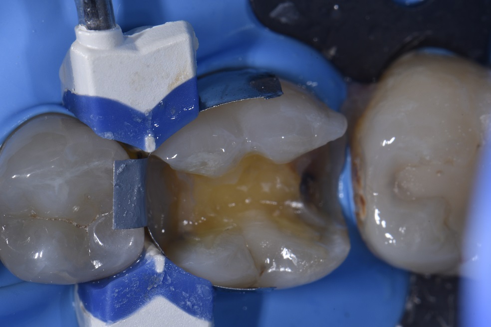 MOD composite restorations