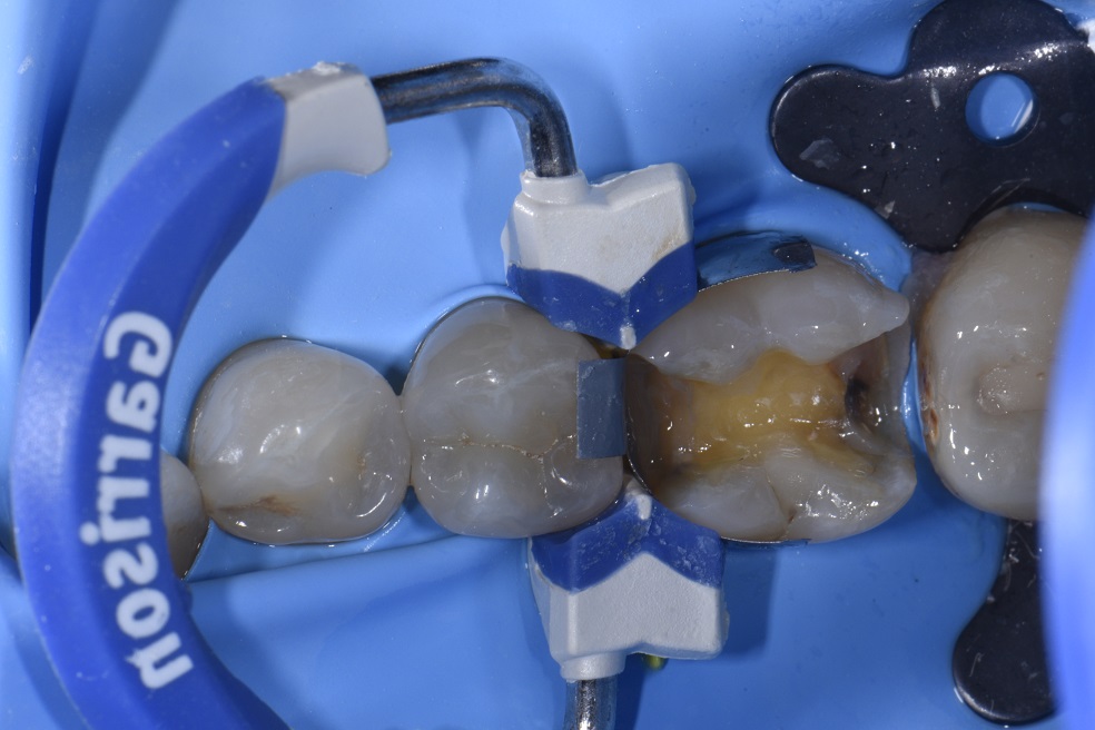 MOD composite restorations