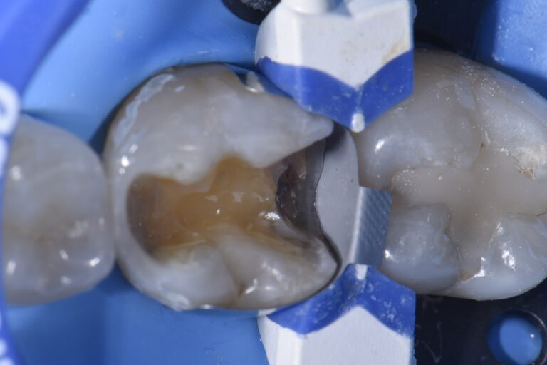 MOD composite restorations