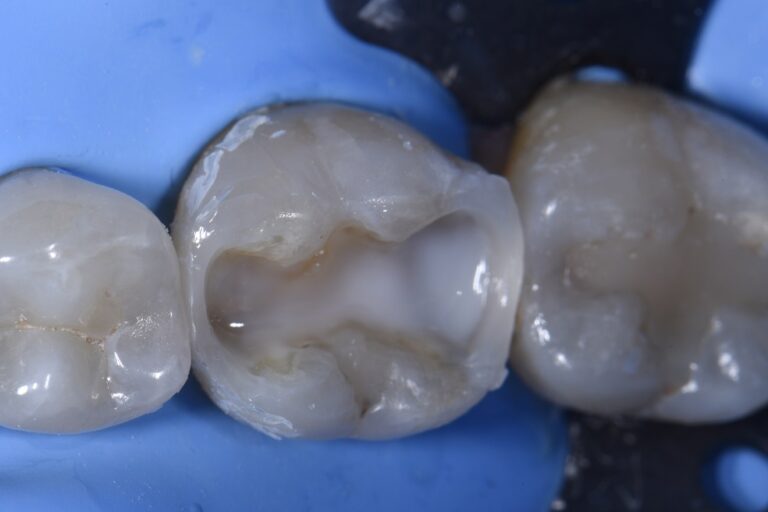 MOD composite restorations