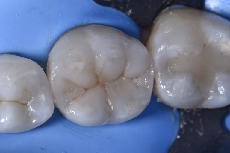 MOD composite restorations