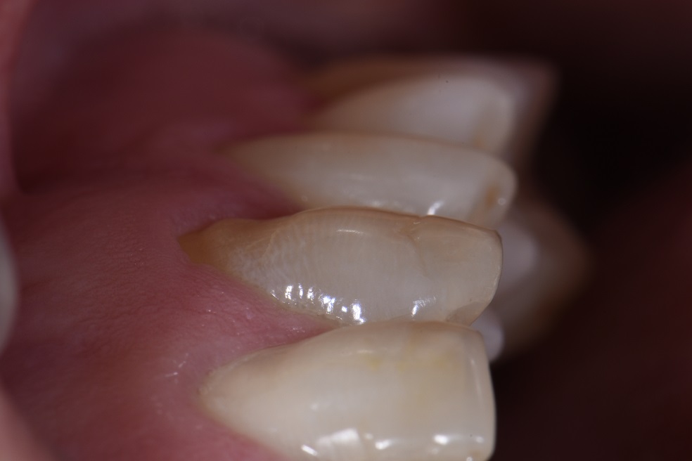 Emergence Profile Detail