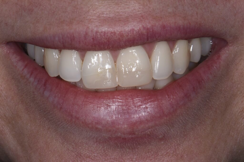 Composite Restorations that Mimic Nature