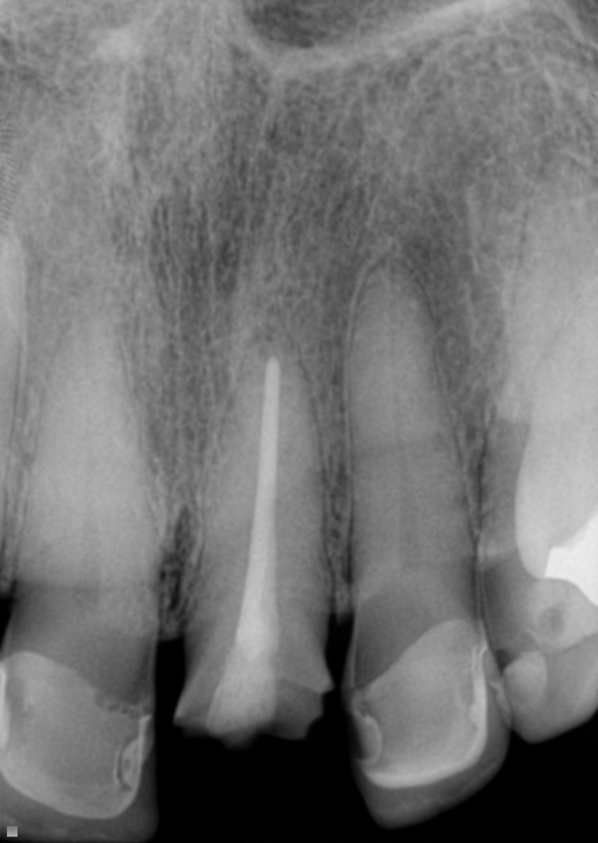 Freehand Composite Crown Fabrication to match Porcelain Veneers