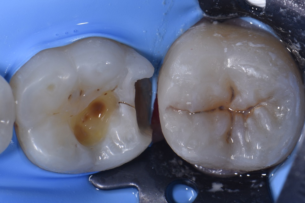 Recreating firm contacts with back to back restorations