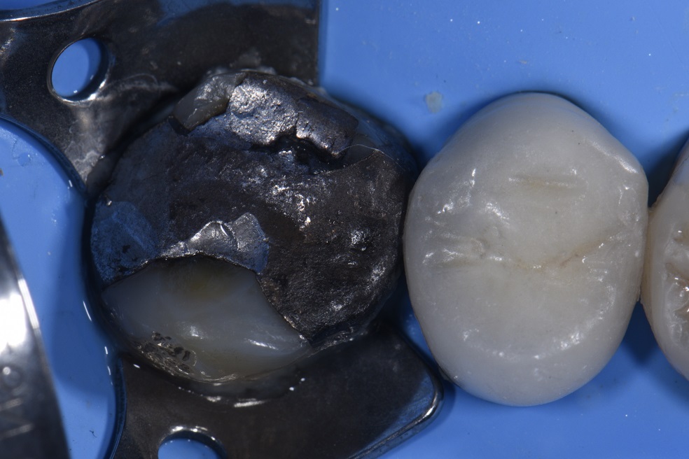 Extensively filled tooth supported with bonded overlay