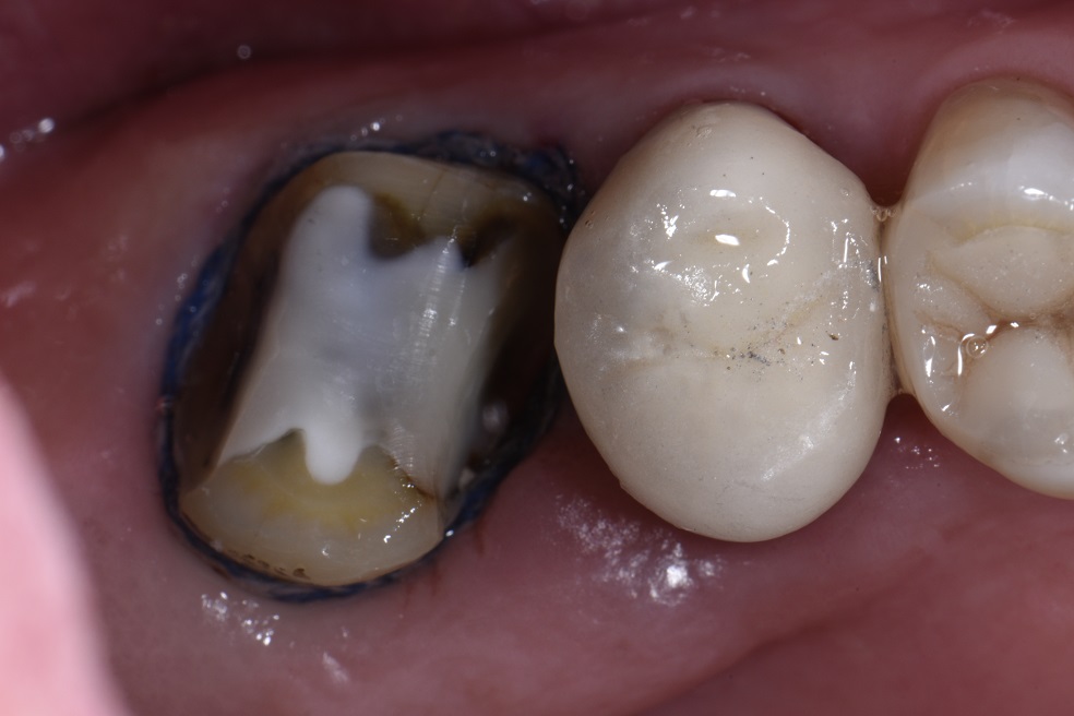 Extensively filled tooth supported with bonded overlay