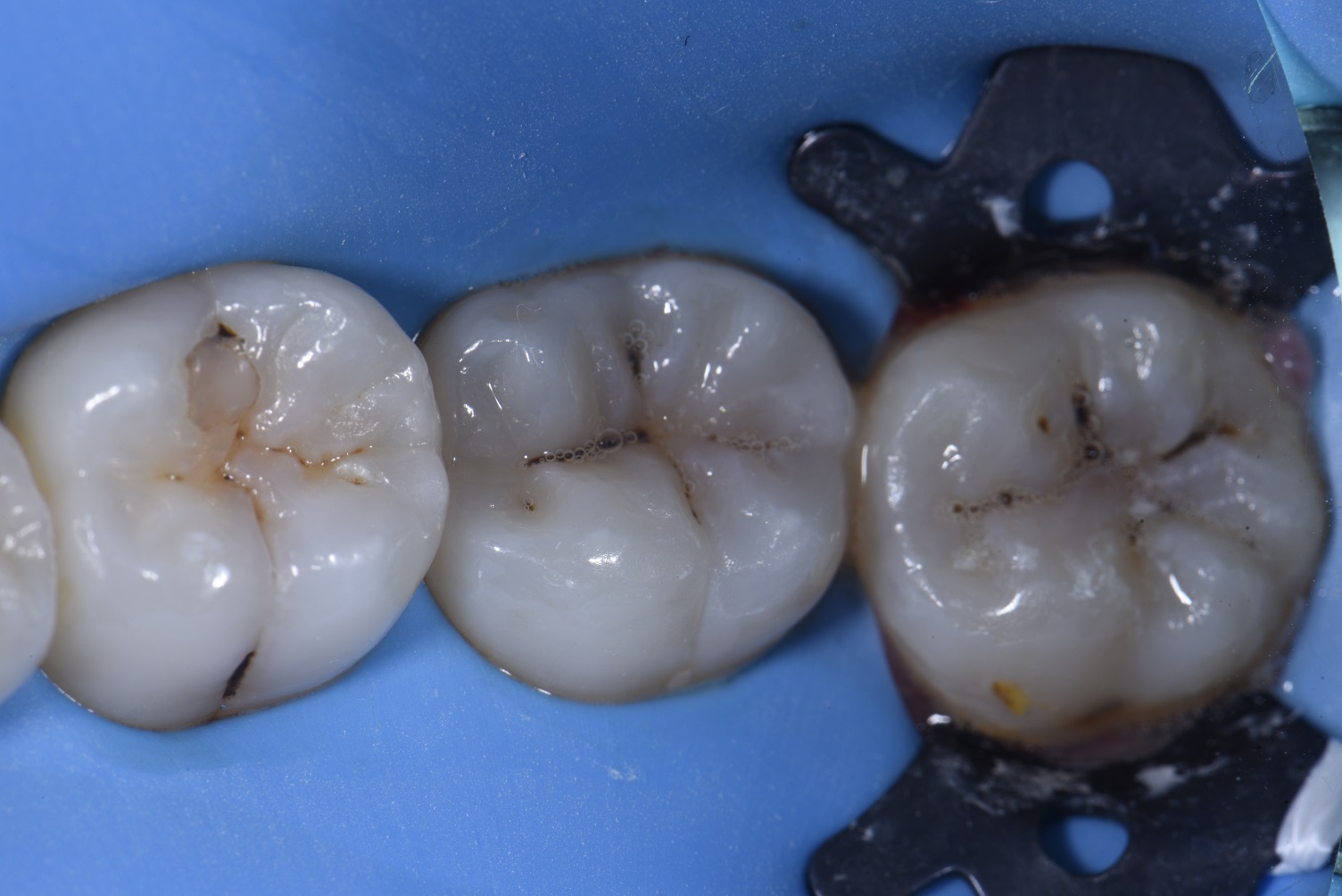 Small cavities restored invisibly