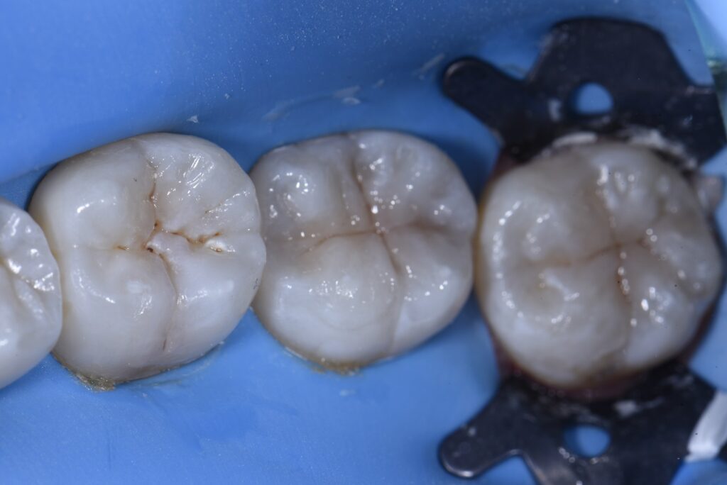 Small cavities restored invisibly