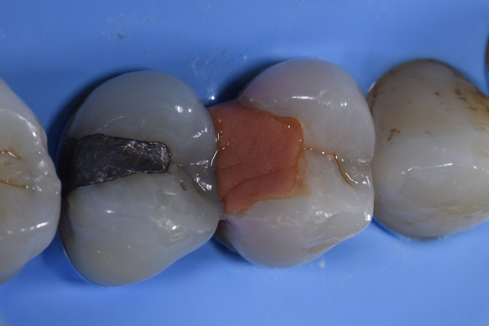 Back to back deep cavities restored seamlessly