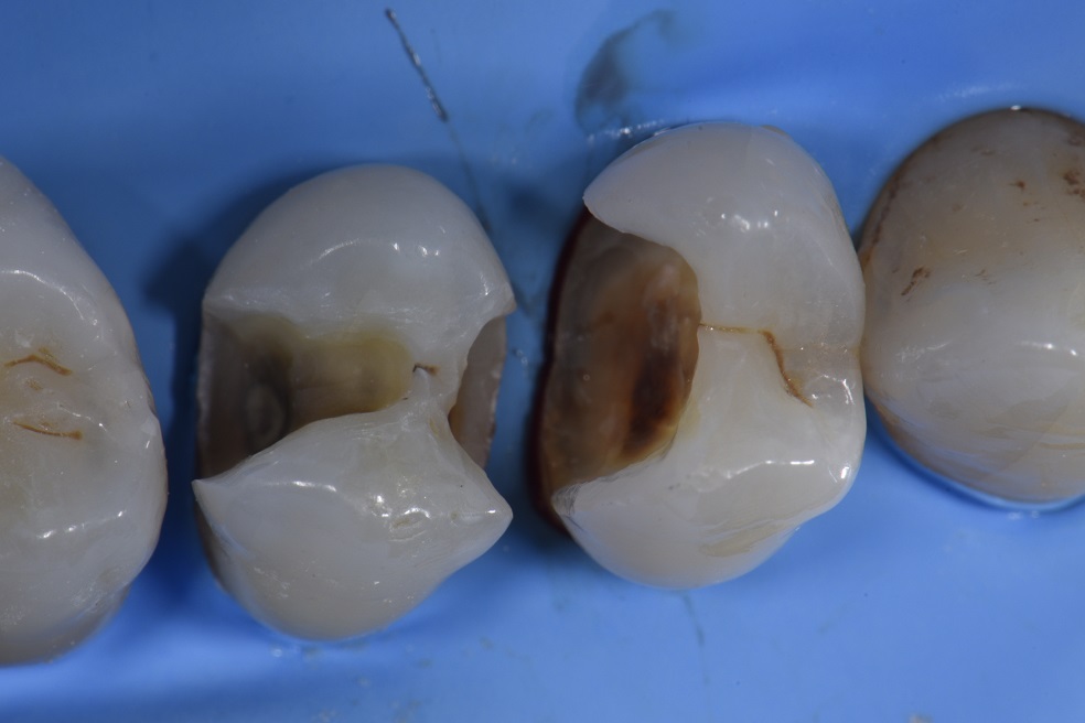 Back to back deep cavities restored seamlessly