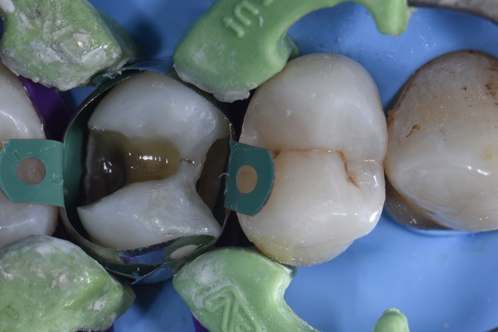 Back to back deep cavities restored seamlessly