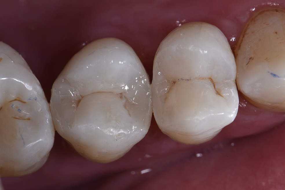 Back to back deep cavities restored seamlessly