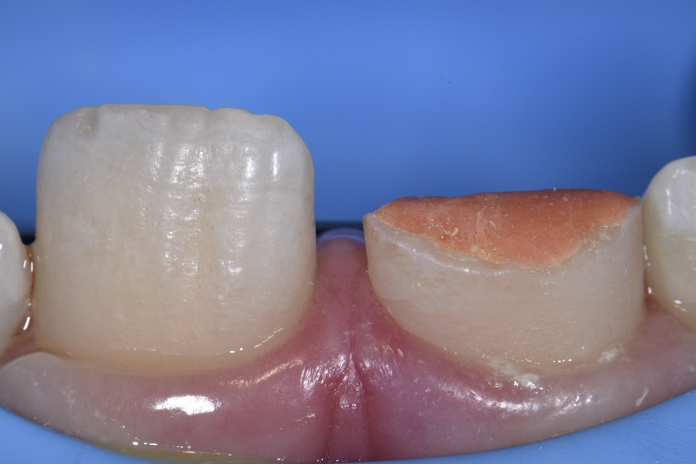 Rebuilding a 10 year old boy's front tooth