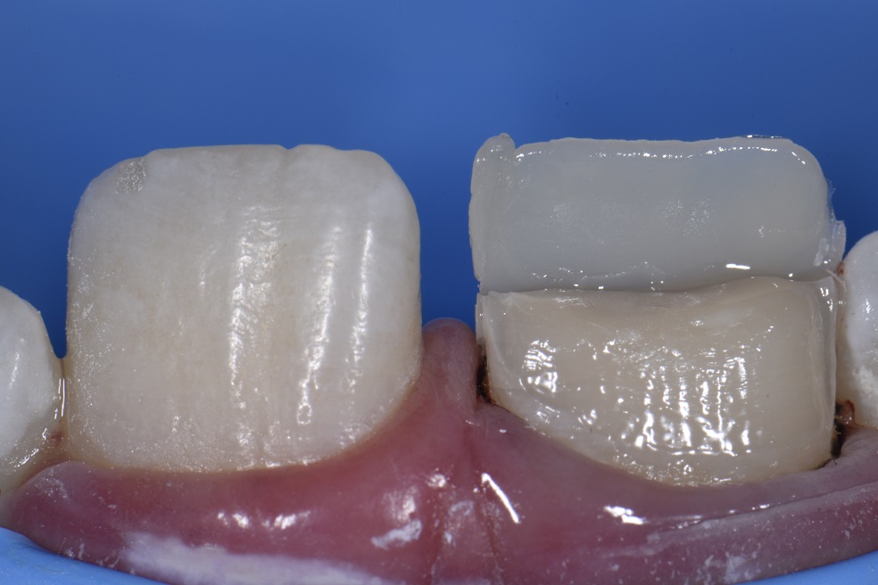 Rebuilding a 10 year old boy's front tooth