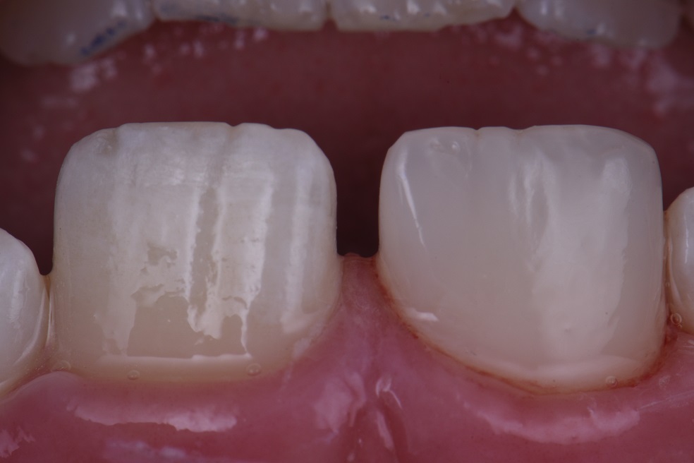 Rebuilding a 10 year old boy's front tooth