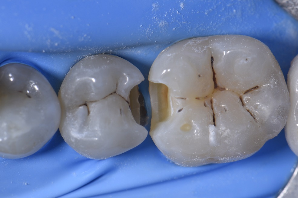 Slot preps preserving tooth structure and rigidity