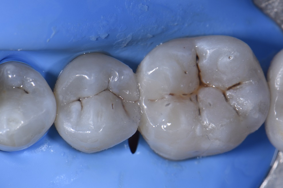 Slot preps preserving tooth structure and rigidity
