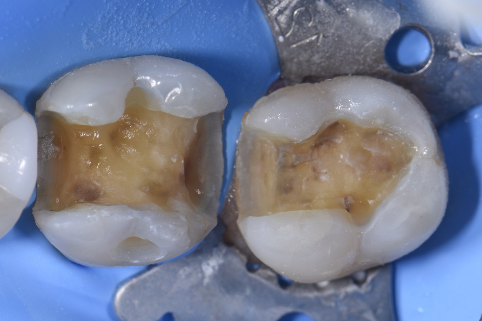 Large Class II replacement restorations with composite