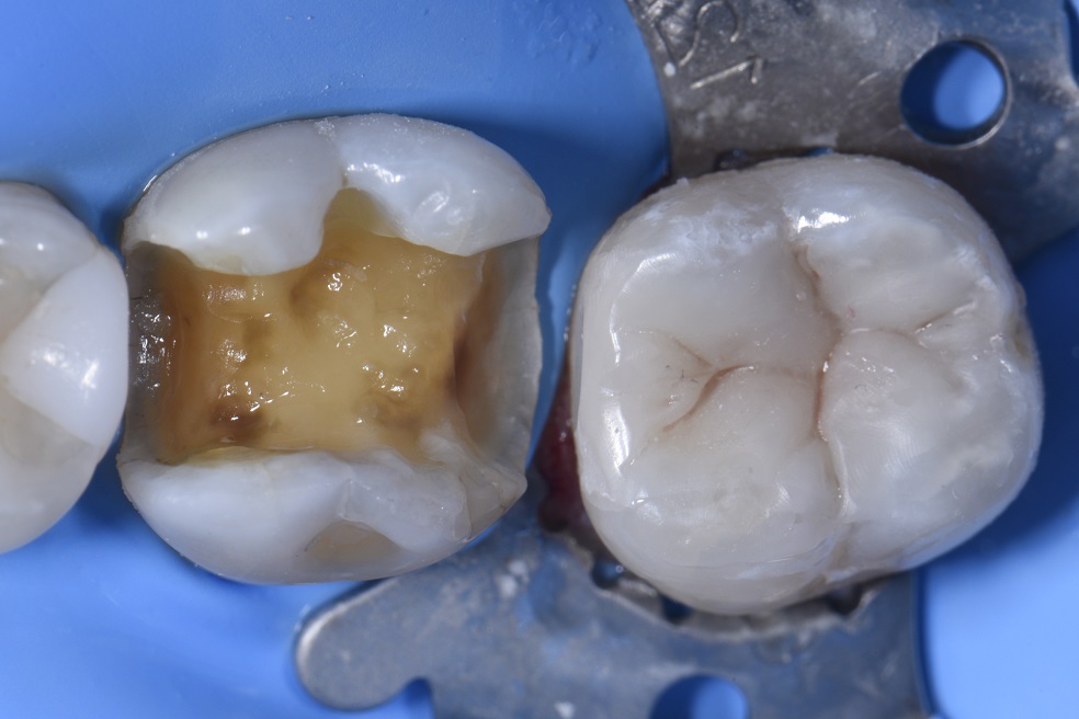Large Class II replacement restorations with composite