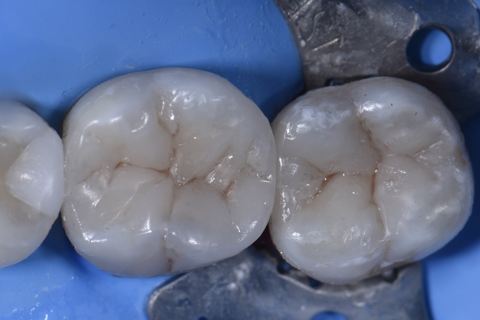 Large Class II replacement restorations with composite