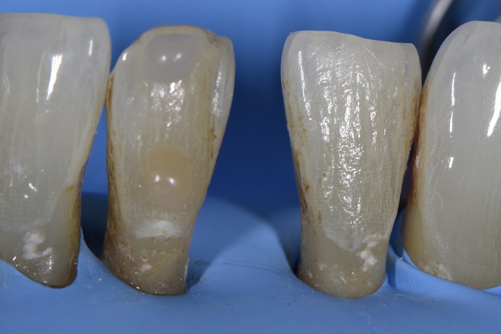 Closing Large Gaps between Teeth with Composite Closing Large Gaps between Teeth with Composite