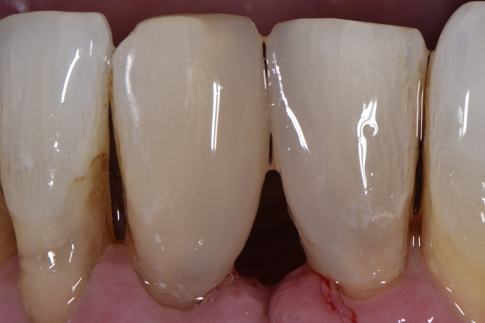 Closing Large Gaps between Teeth with Composite Closing Large Gaps between Teeth with Composite