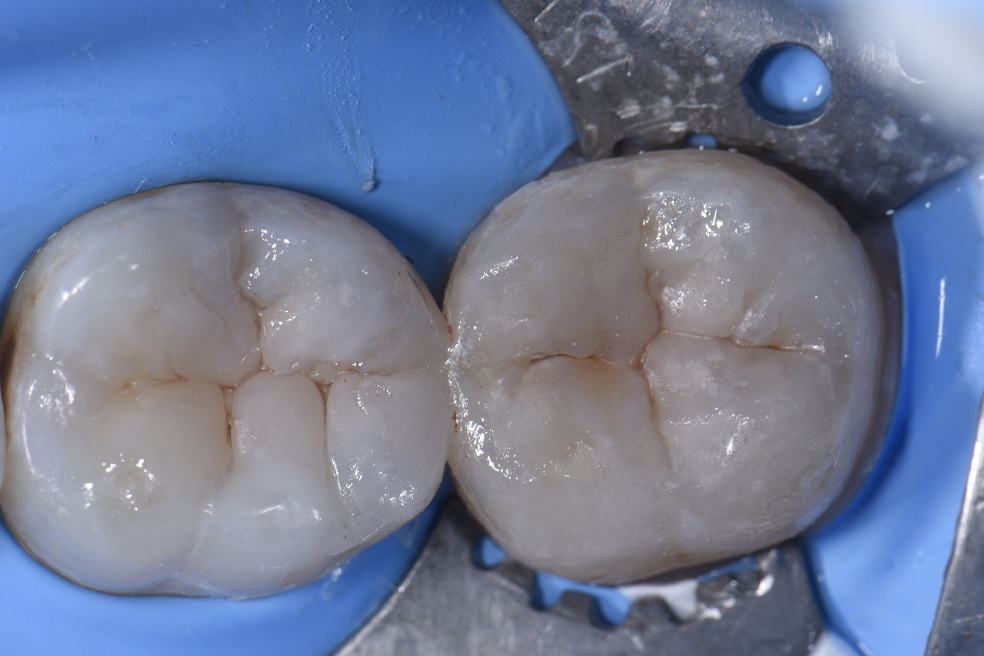 Conservative Preparations for Occlusal Caries