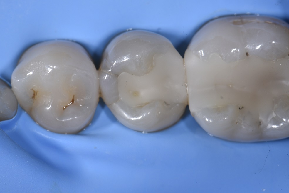 Partial Restoration Replacements