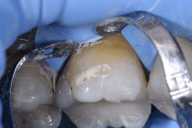 Absolute Isolation for Class V restorations
