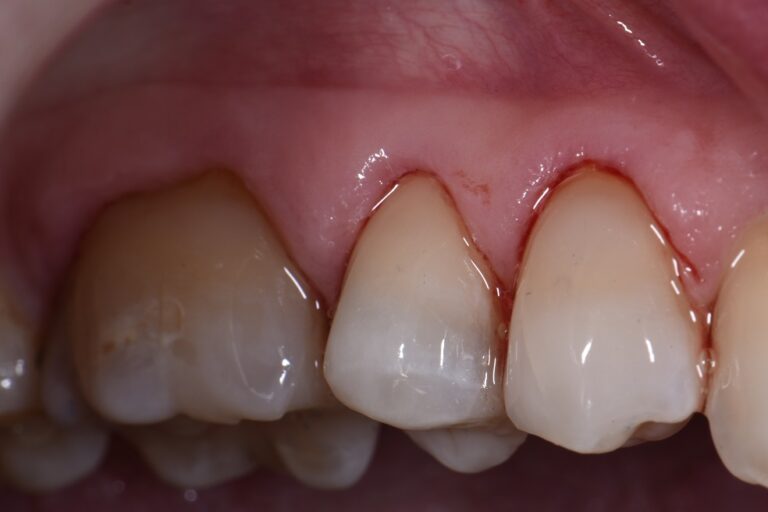 Absolute Isolation for Class V restorations