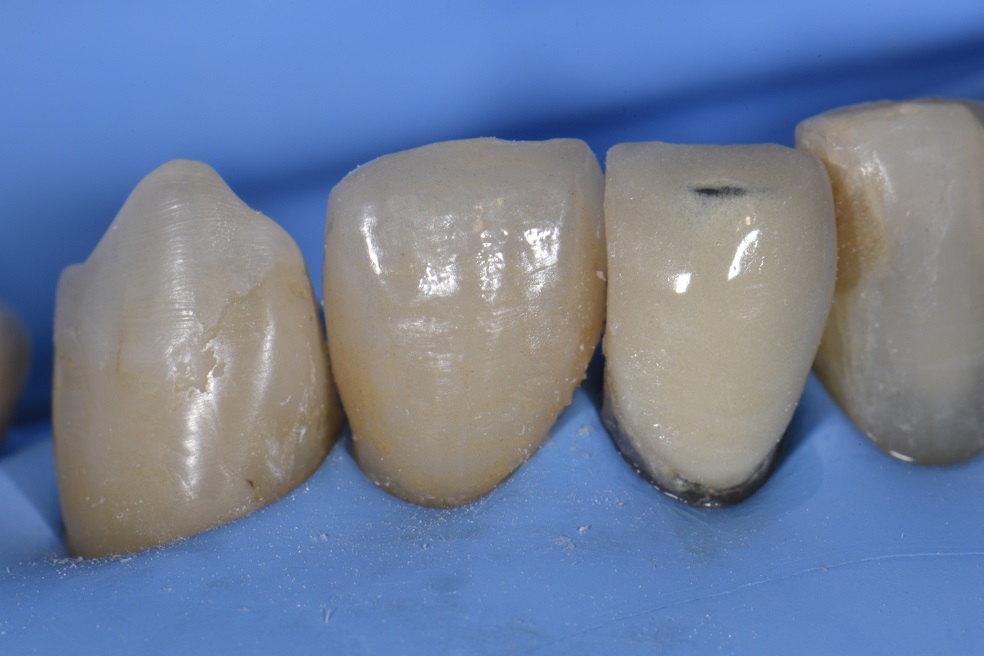 Absolute Isolation with Rubber Dam Adhesive Cementation