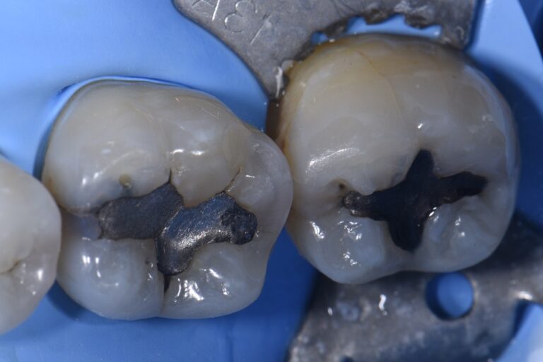 Peripheral Rim Fractures from Amalgam Restorations