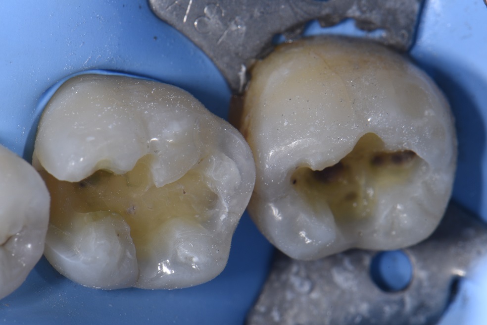 Peripheral Rim Fractures from Amalgam Restorations