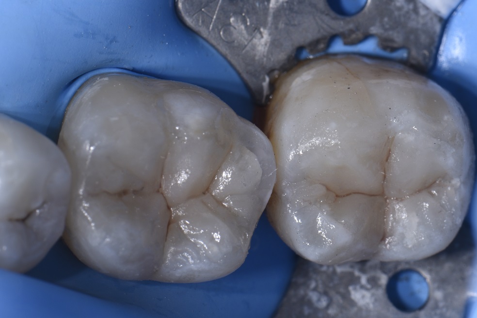 Peripheral Rim Fractures from Amalgam Restorations