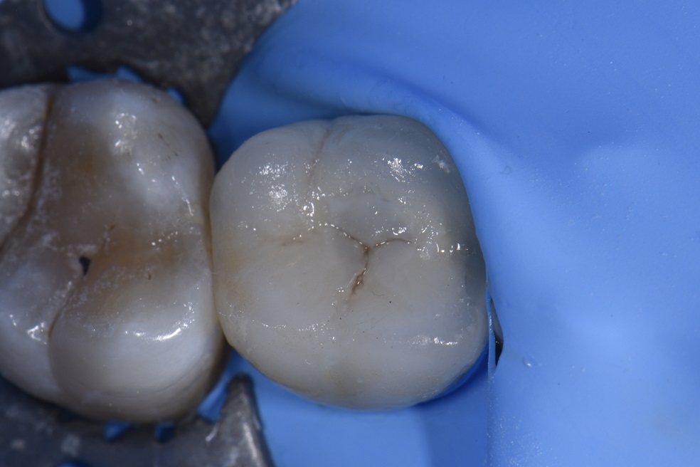 Obscuring Implant Screw Access Channels