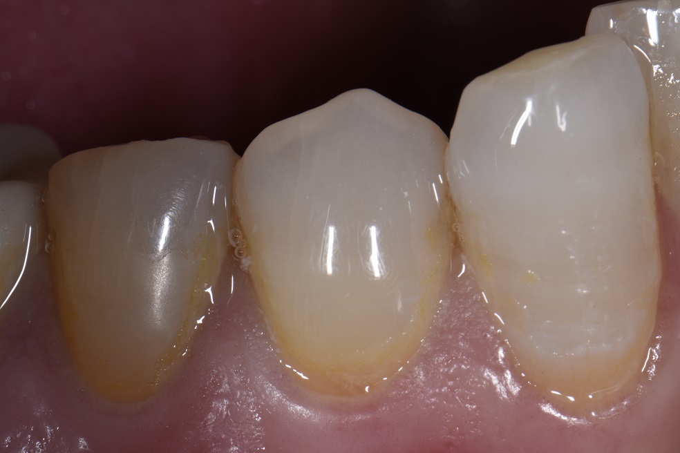 Micro Micro Layers in Class V applications