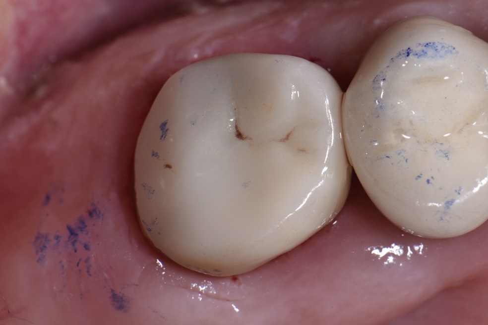 Extensively filled tooth supported with bonded overlay