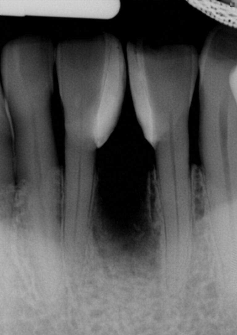Closing Large Gaps between Teeth with Composite