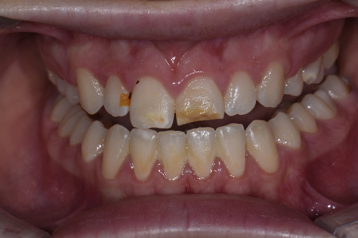 Correction of Hypoplasia and Hypomineralization on a 15 year old female