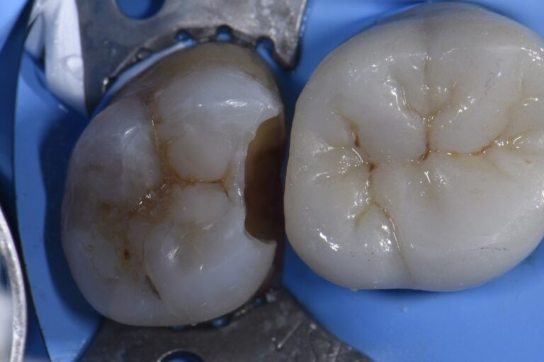 Deep Margin Elevation in Restorative Dentistry